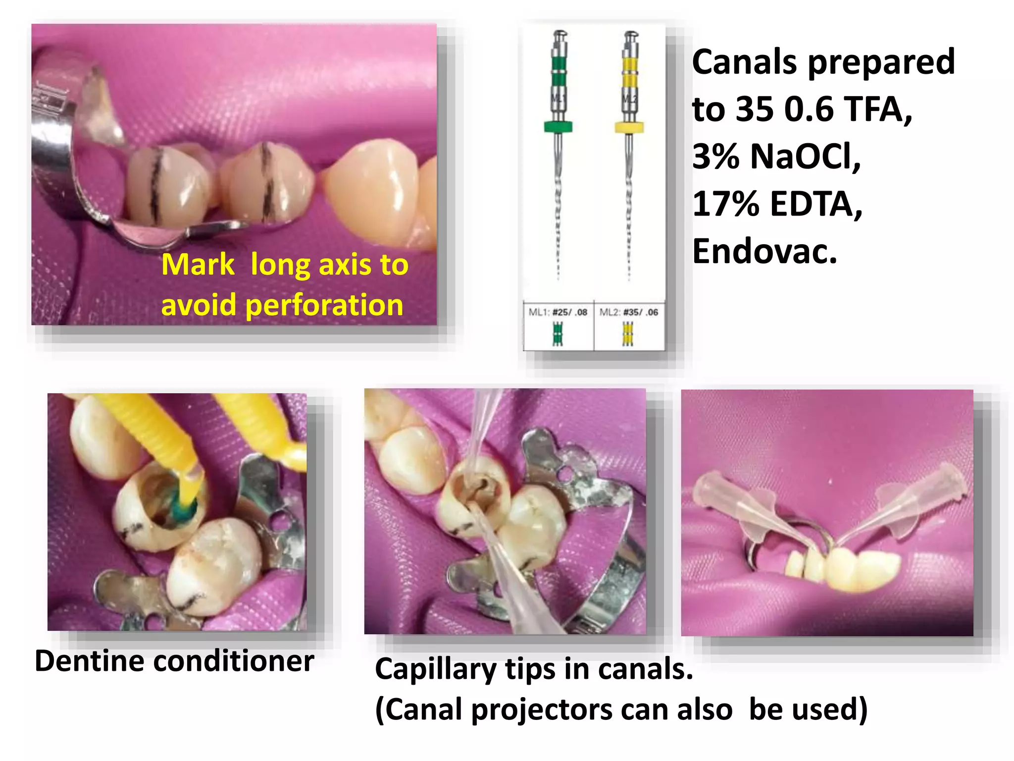 Supra crestal perforation repair, endodontics , mishaps | PPTX