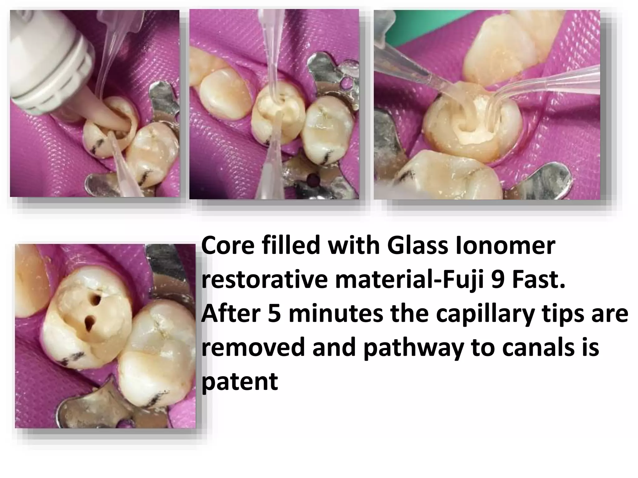 Supra crestal perforation repair, endodontics , mishaps | PPTX