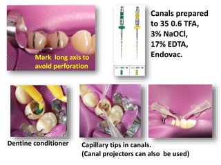 Supra crestal perforation repair, endodontics , mishaps | PPTX