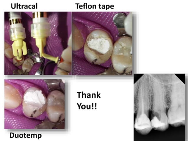 Supra crestal perforation repair, endodontics , mishaps | PPT