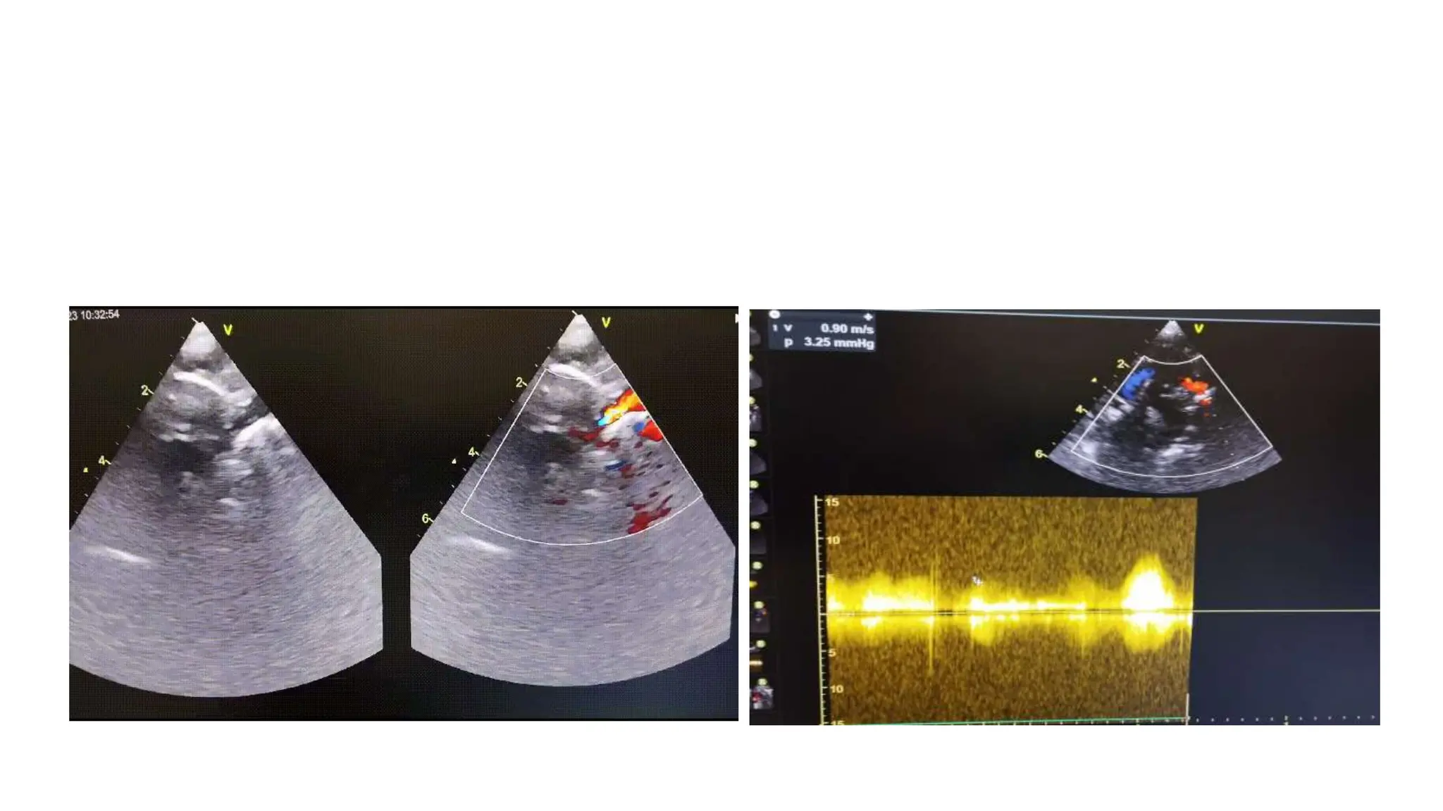 Supracardiac TAPVR with obstructive.pptx