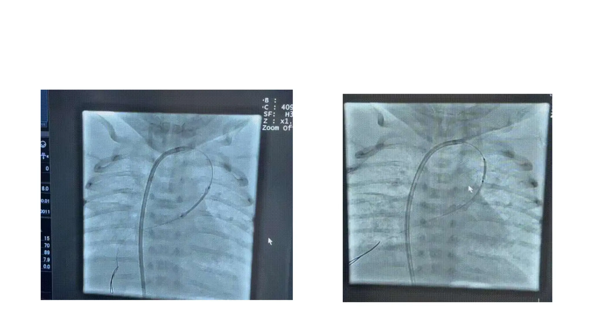 Supracardiac TAPVR with obstructive.pptx