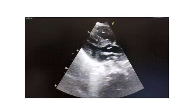 Supracardiac TAPVR with obstructive.pptx