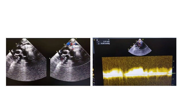Supracardiac TAPVR with obstructive.pptx