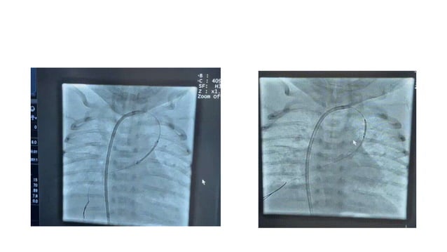 Supracardiac TAPVR with obstructive.pptx