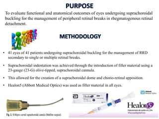 Suprachoroidal Buckling BY DR.PUSHKAR DHIR.pptx | Eye and Vision ...
