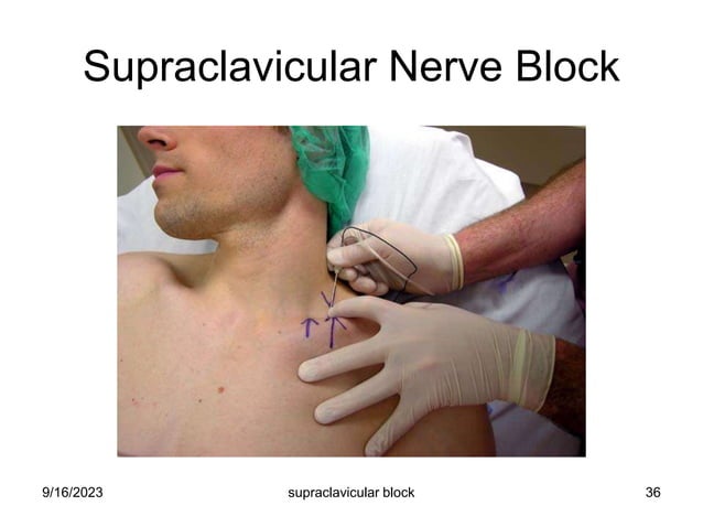 supra clavicular block.ppt