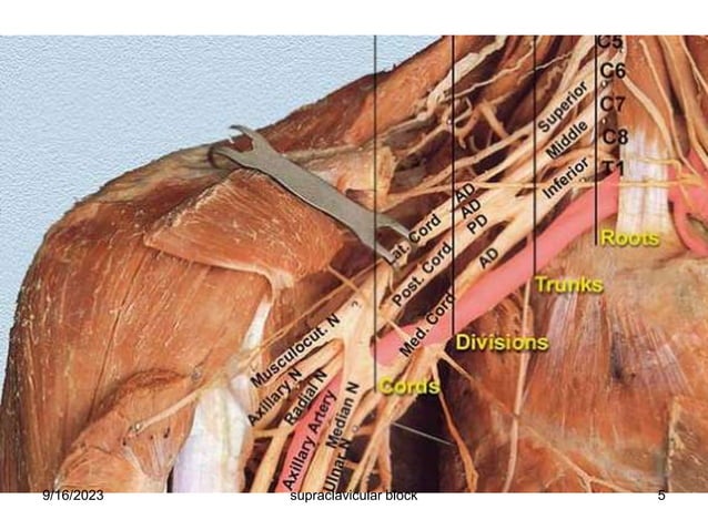 supra clavicular block.ppt