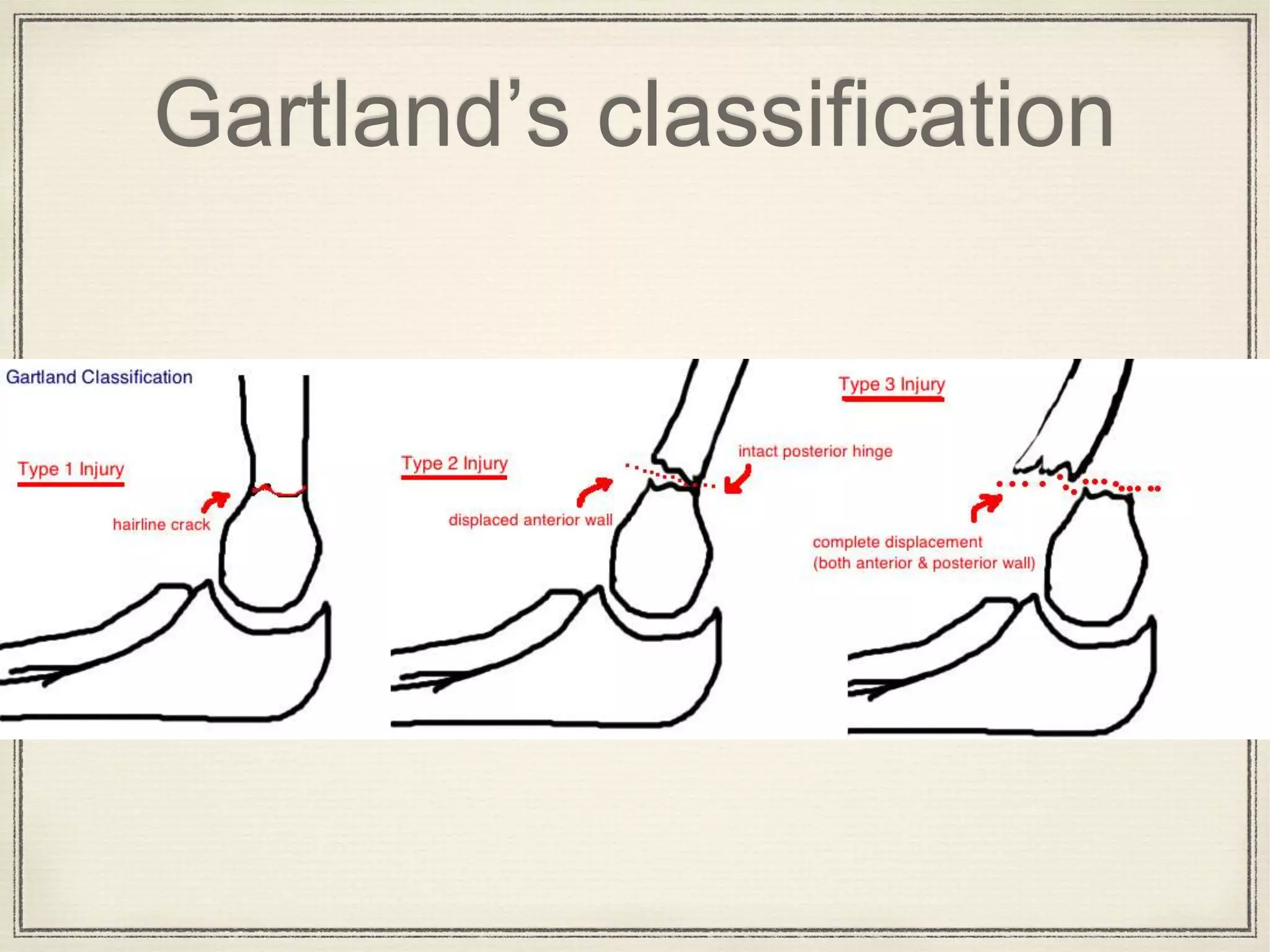 Supracondylar fracture | PPTX