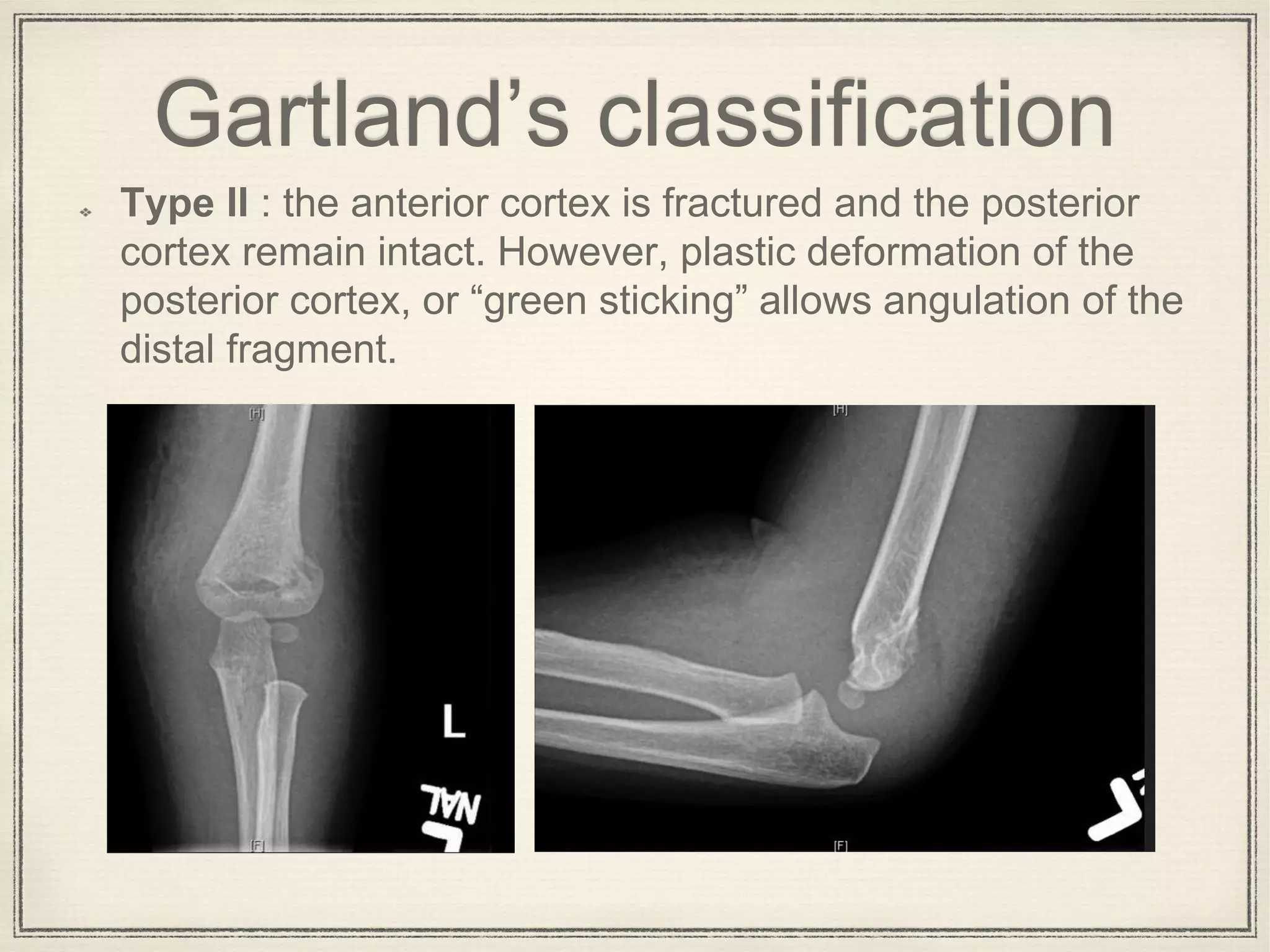 Supracondylar fracture | PPTX