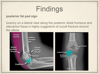 Supracondylar fracture | PPT