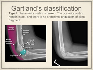 Supracondylar fracture | PPT