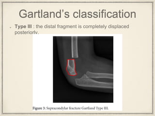 Supracondylar fracture | PPT