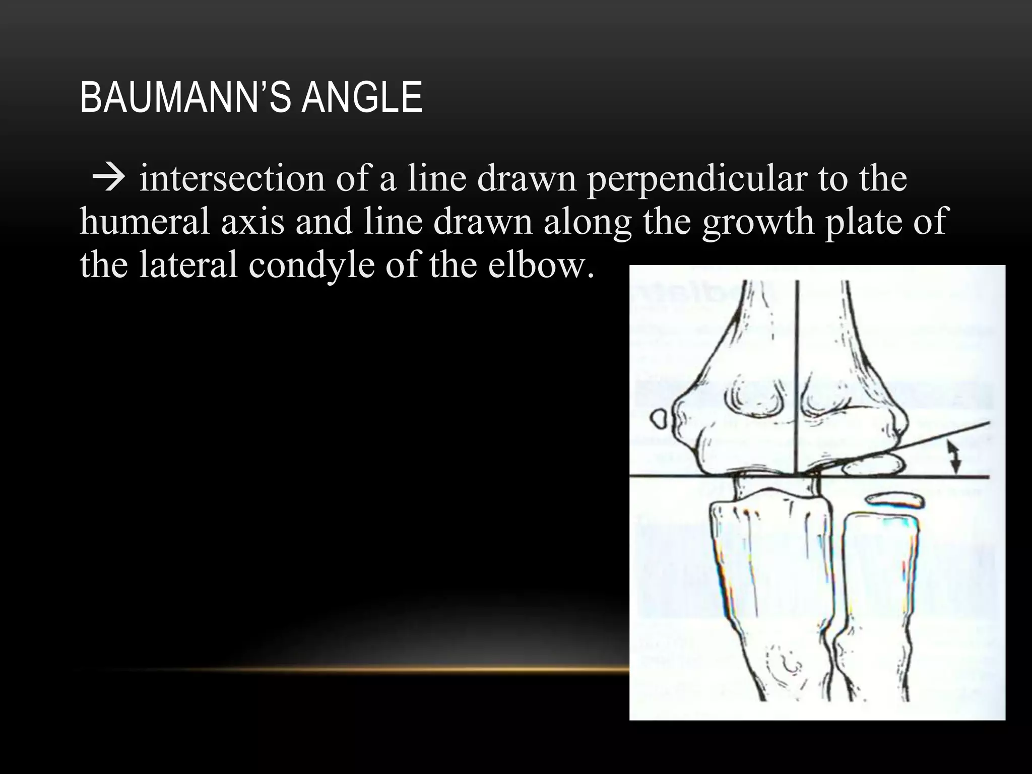 Supra condylar fracture.pptx