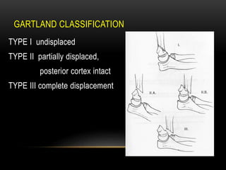 Supra condylar fracture.pptx