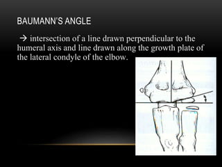 Supra condylar fracture.pptx