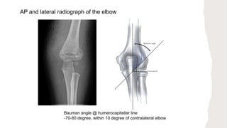 Supracondylar Fracture.pptx