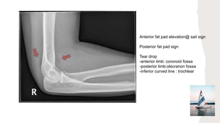 Supracondylar Fracture.pptx