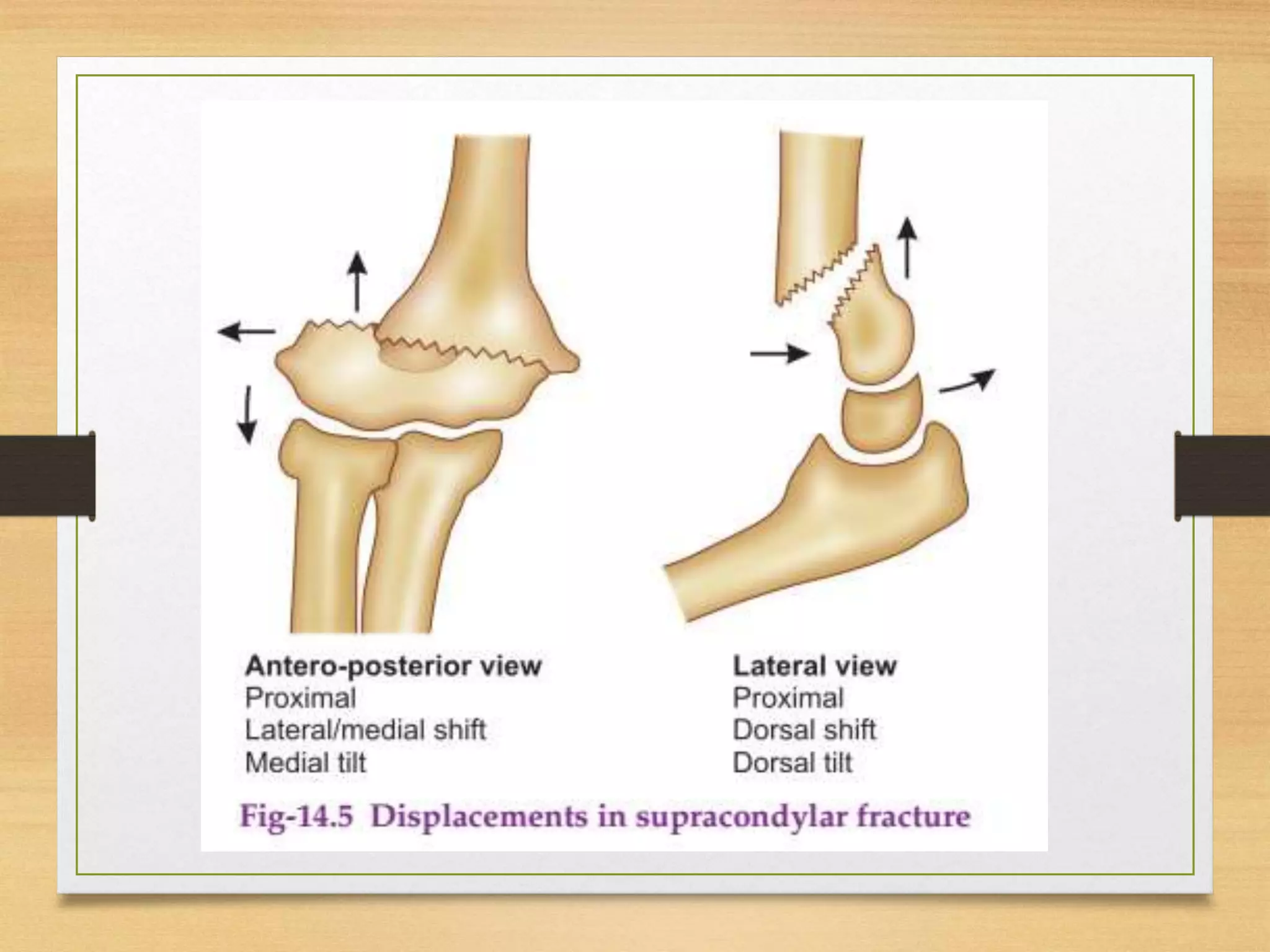 Supracondylar fracture- Dr Sundar Ortho.pptx