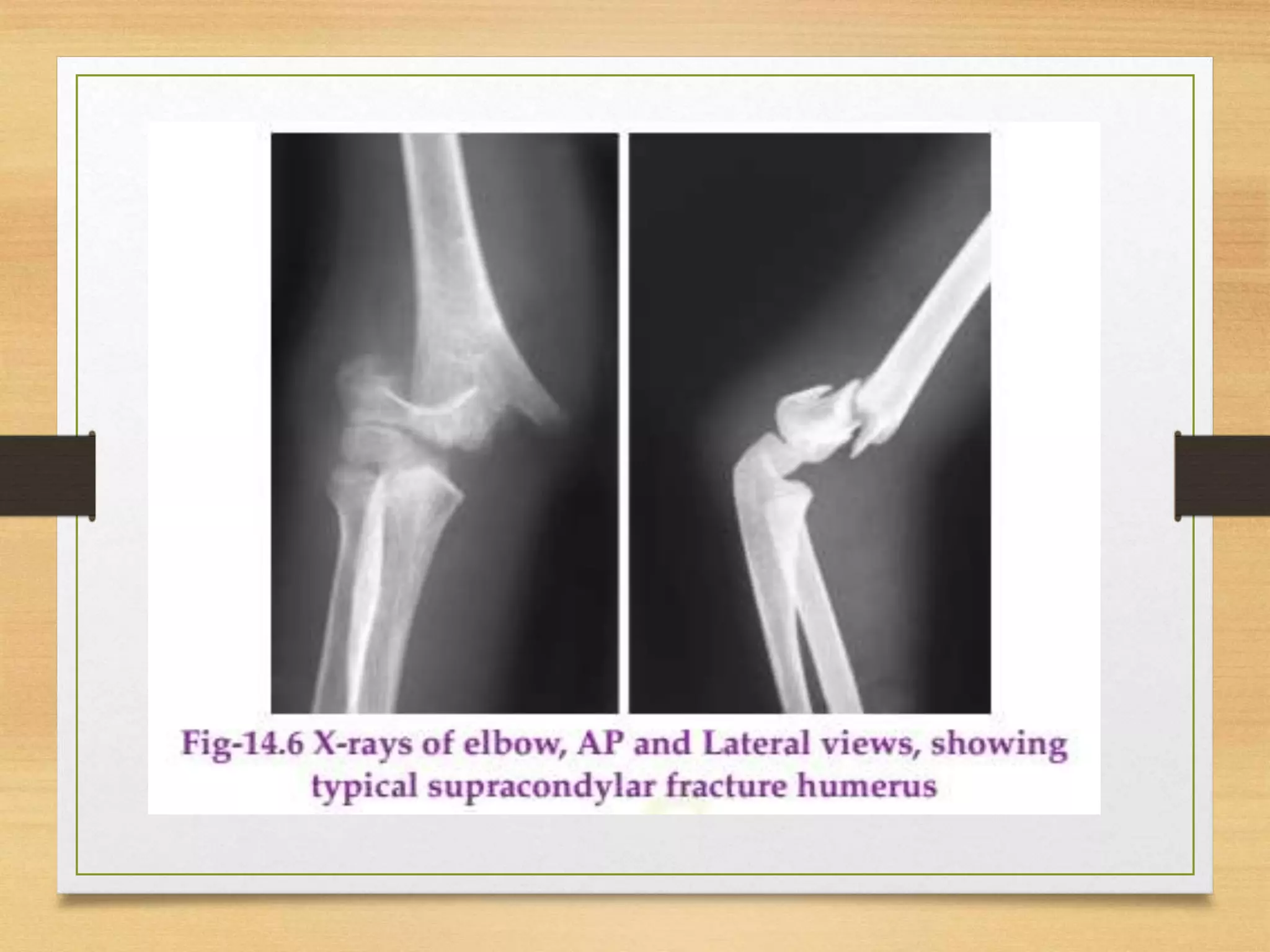 Supracondylar fracture- Dr Sundar Ortho.pptx