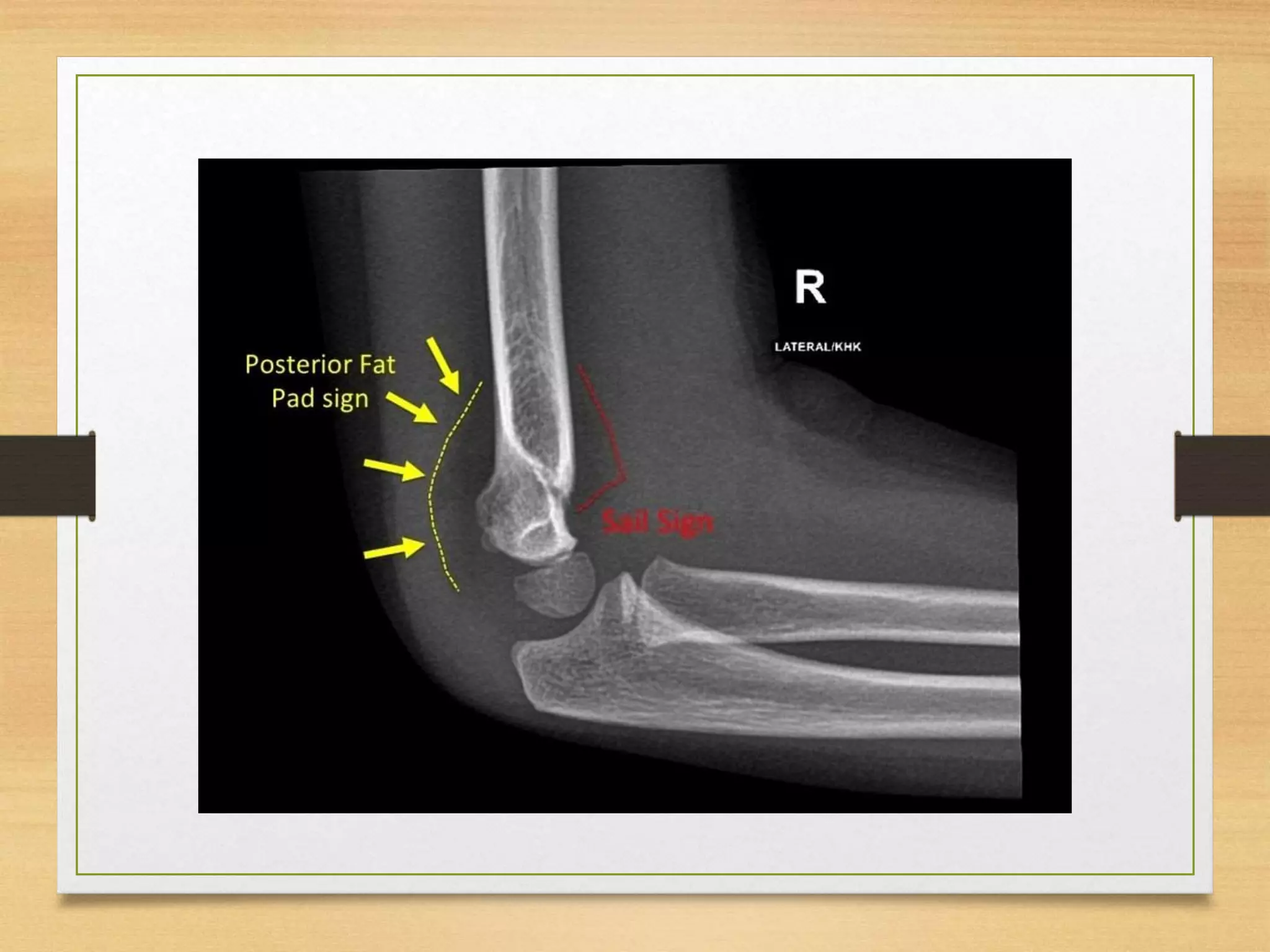 Supracondylar fracture- Dr Sundar Ortho.pptx