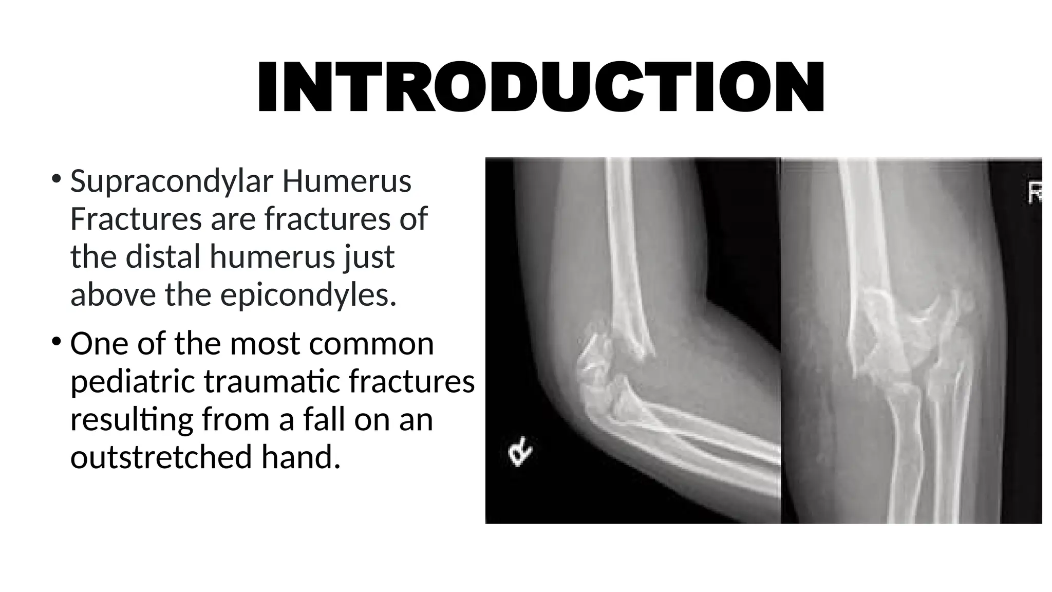 SUPRACONDYLAR FRACTURE - PAEDIATRIC.pptx