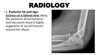 SUPRACONDYLAR FRACTURE - PAEDIATRIC.pptx