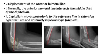 SUPRACONDYLAR FRACTURE - PAEDIATRIC.pptx