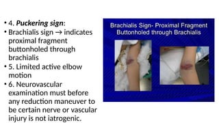 SUPRACONDYLAR FRACTURE - PAEDIATRIC.pptx