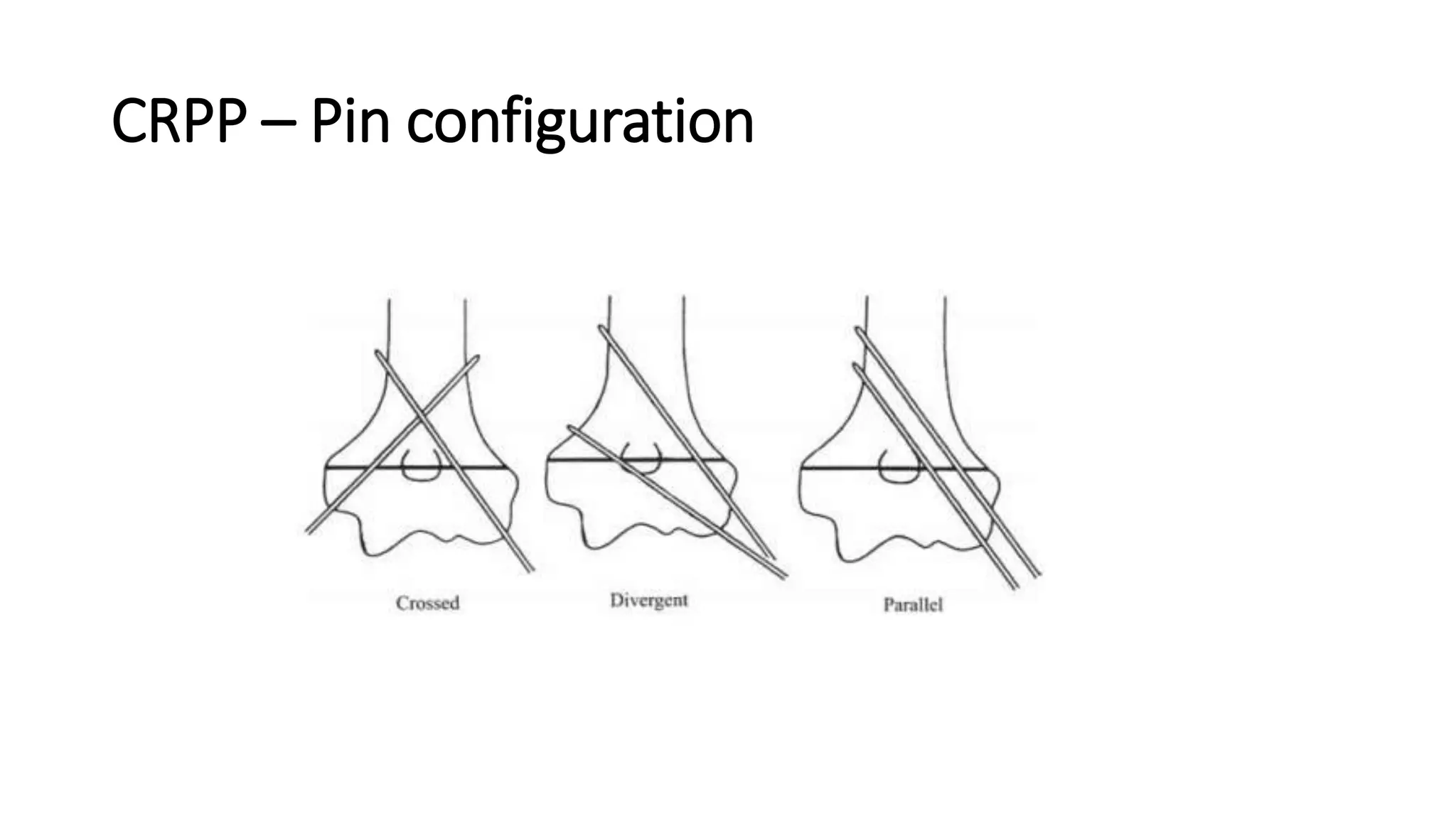 Supracondylar Fractures | PPTX