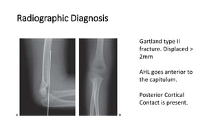 Supracondylar Fractures | PPTX