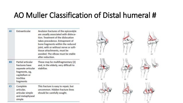 Supracondylar Fractures