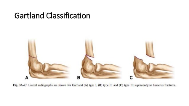 Supracondylar Fractures