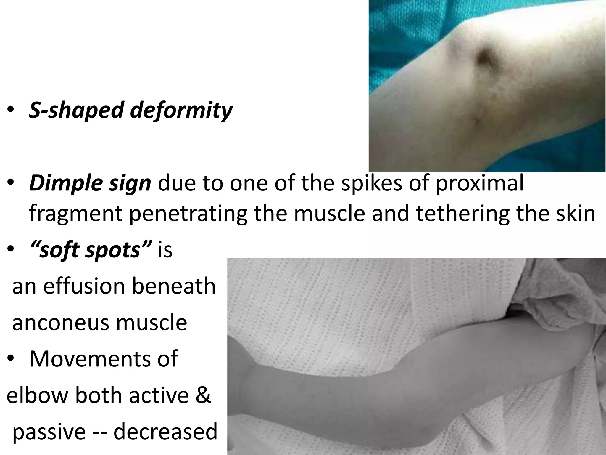 Supracondylar fracture of the humerus by phaneendra akana | PPTX