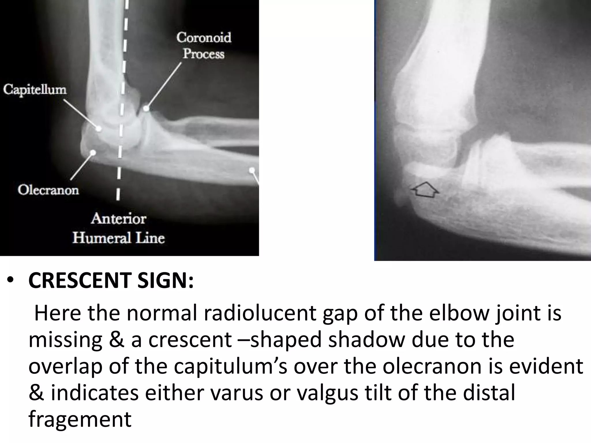 Supracondylar fracture of the humerus by phaneendra akana | PPTX