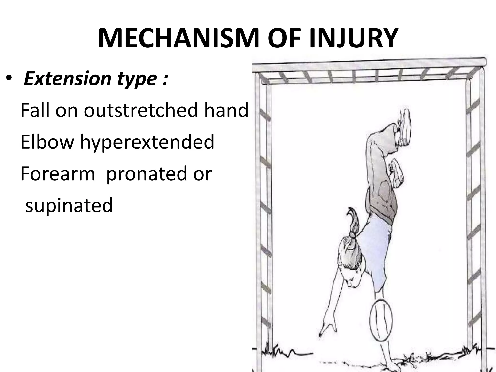 Supracondylar fracture of the humerus by phaneendra akana | PPTX