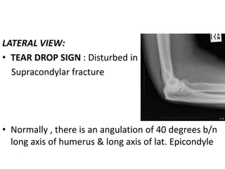 Supracondylar fracture of the humerus by phaneendra akana | PPTX