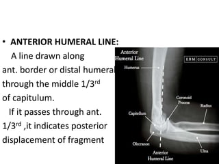 Supracondylar fracture of the humerus by phaneendra akana | PPTX