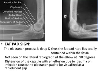 Supracondylar fracture of the humerus by phaneendra akana | PPTX