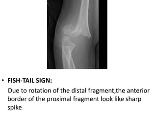 Supracondylar fracture of the humerus by phaneendra akana | PPTX