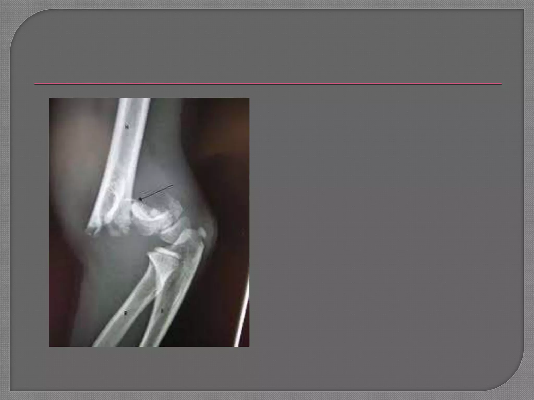 supracondylarfractureofthehumerus-180125165039.pdf