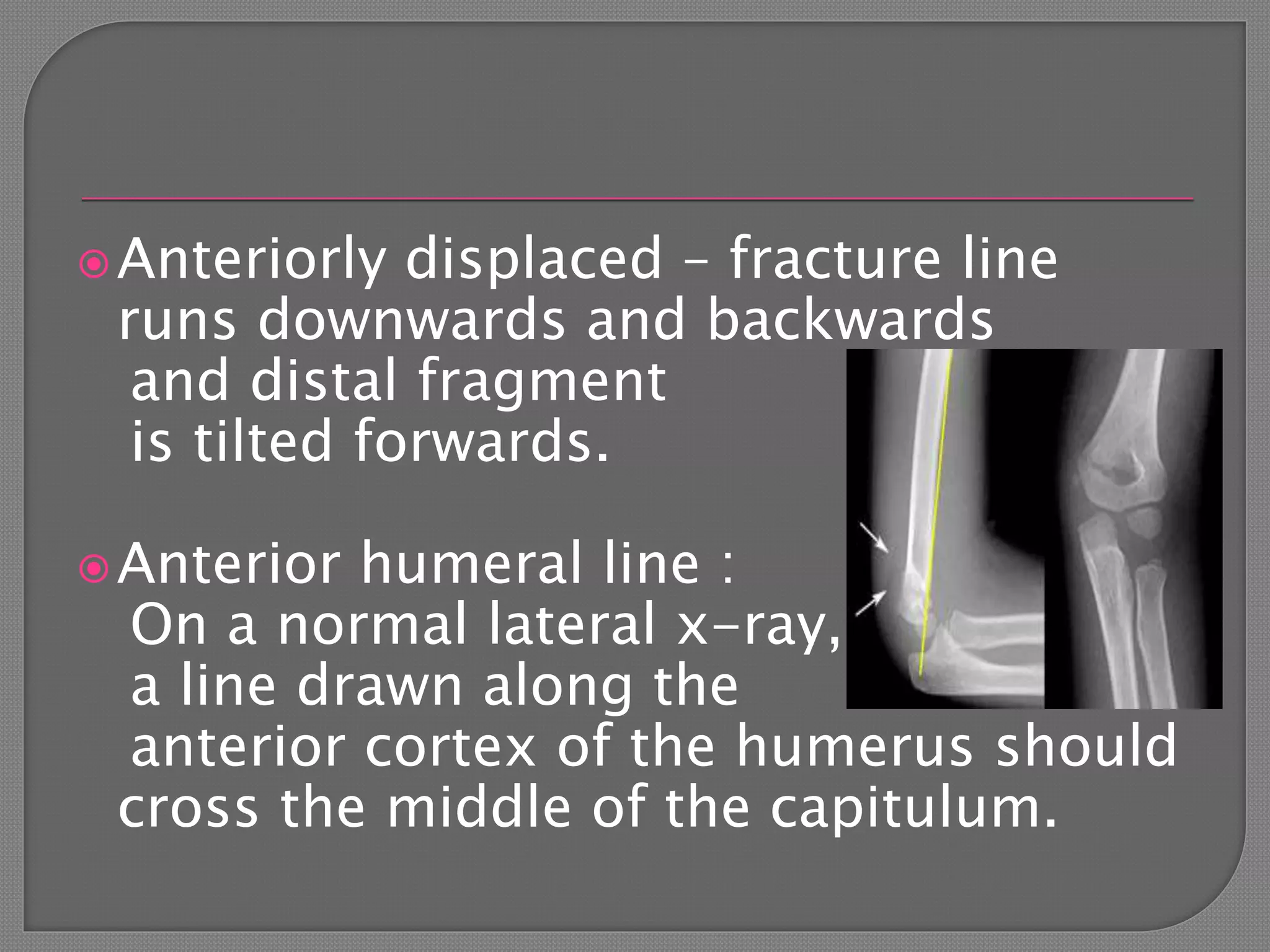 Supracondylar fracture of the humerus | PPTX