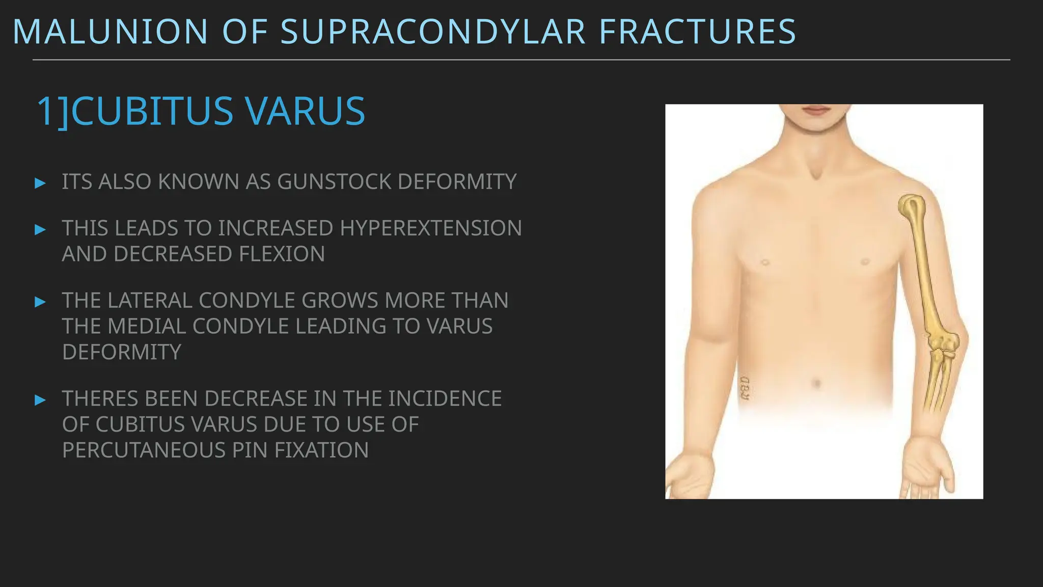 SUPRACONDYLAR FRACTURES OF HUMERUS IN CHILDREN.pptx