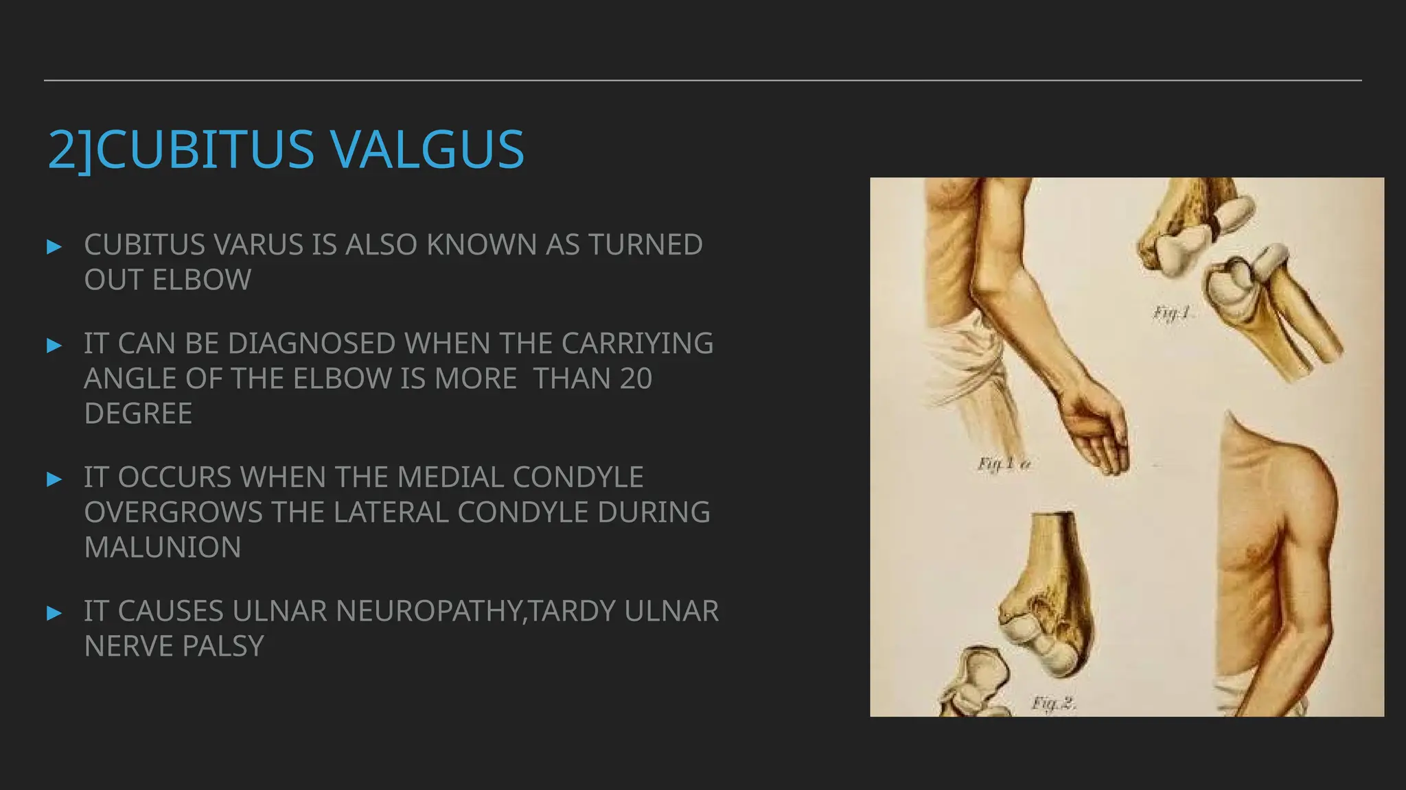 SUPRACONDYLAR FRACTURES OF HUMERUS IN CHILDREN.pptx