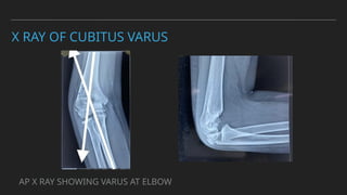 SUPRACONDYLAR FRACTURES OF HUMERUS IN CHILDREN.pptx