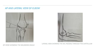 SUPRACONDYLAR FRACTURES OF HUMERUS IN CHILDREN.pptx