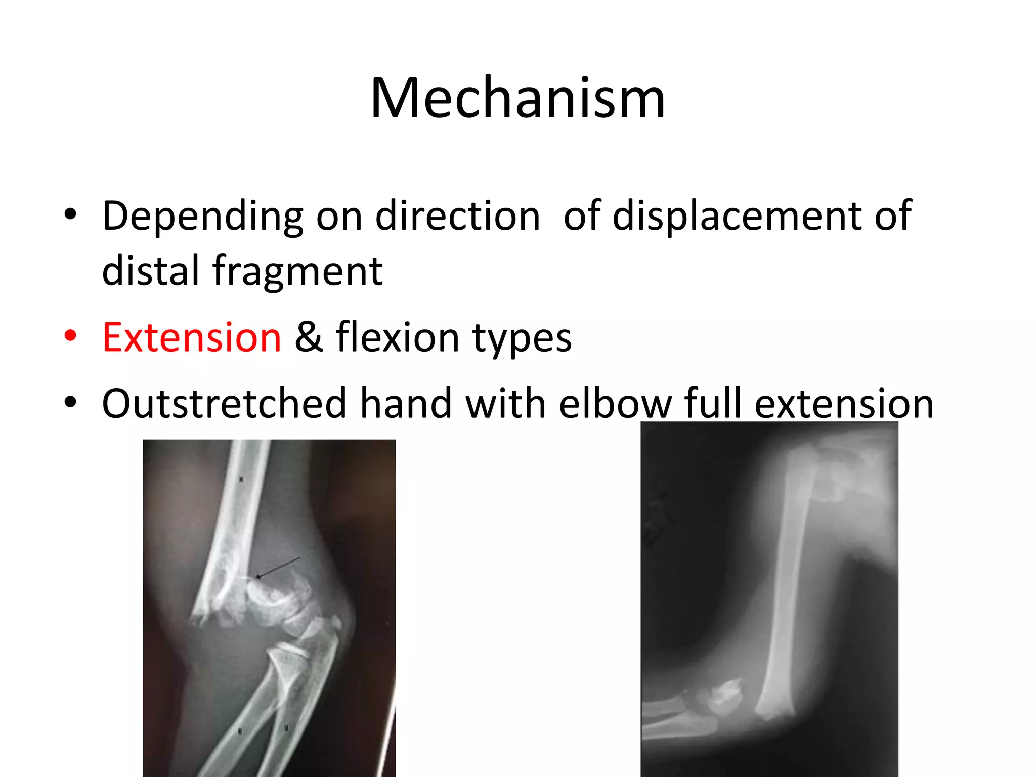 Supracondylar fractures humerus | PPTX