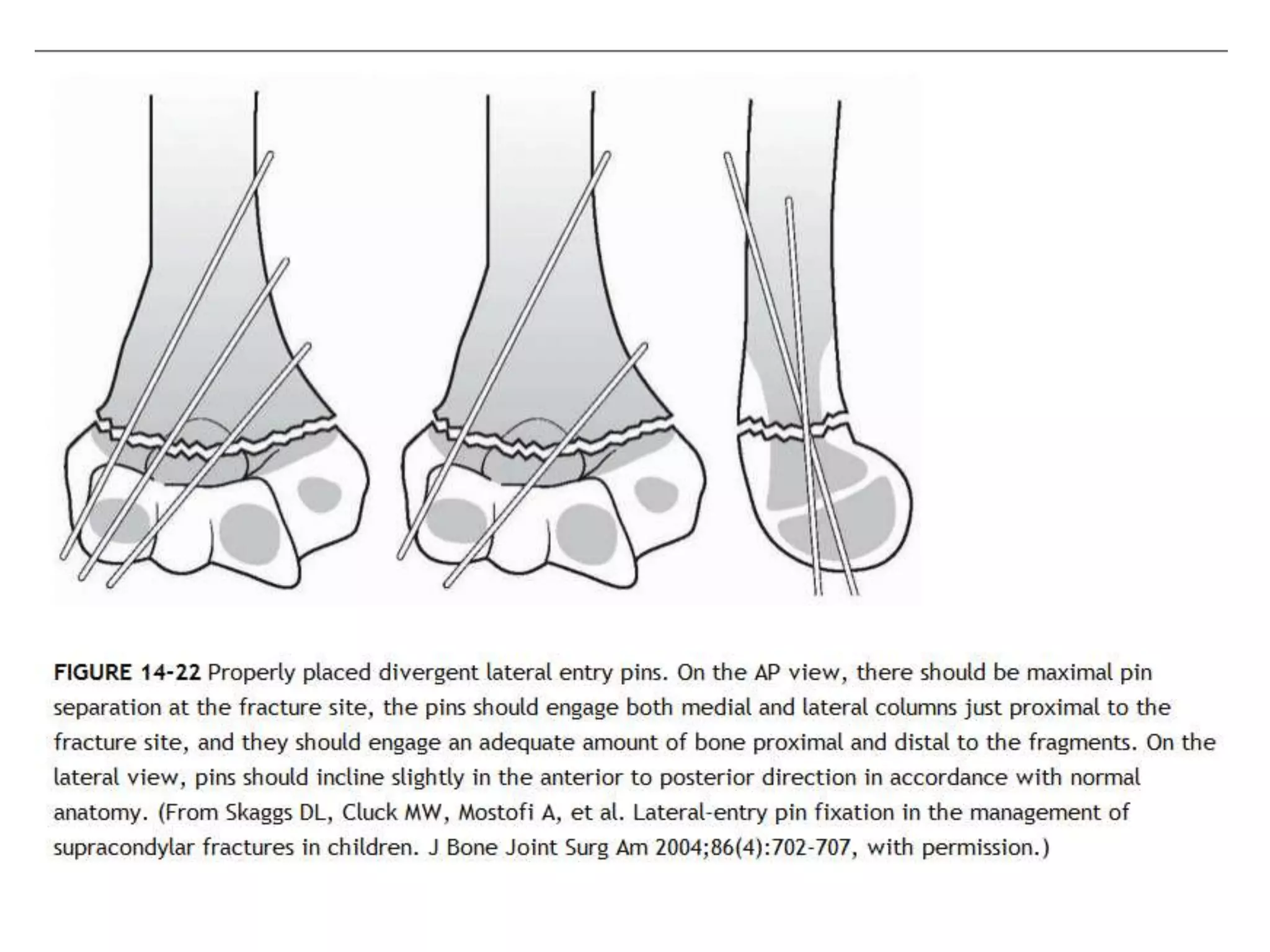 Supracondylar fractures humerus | PPTX