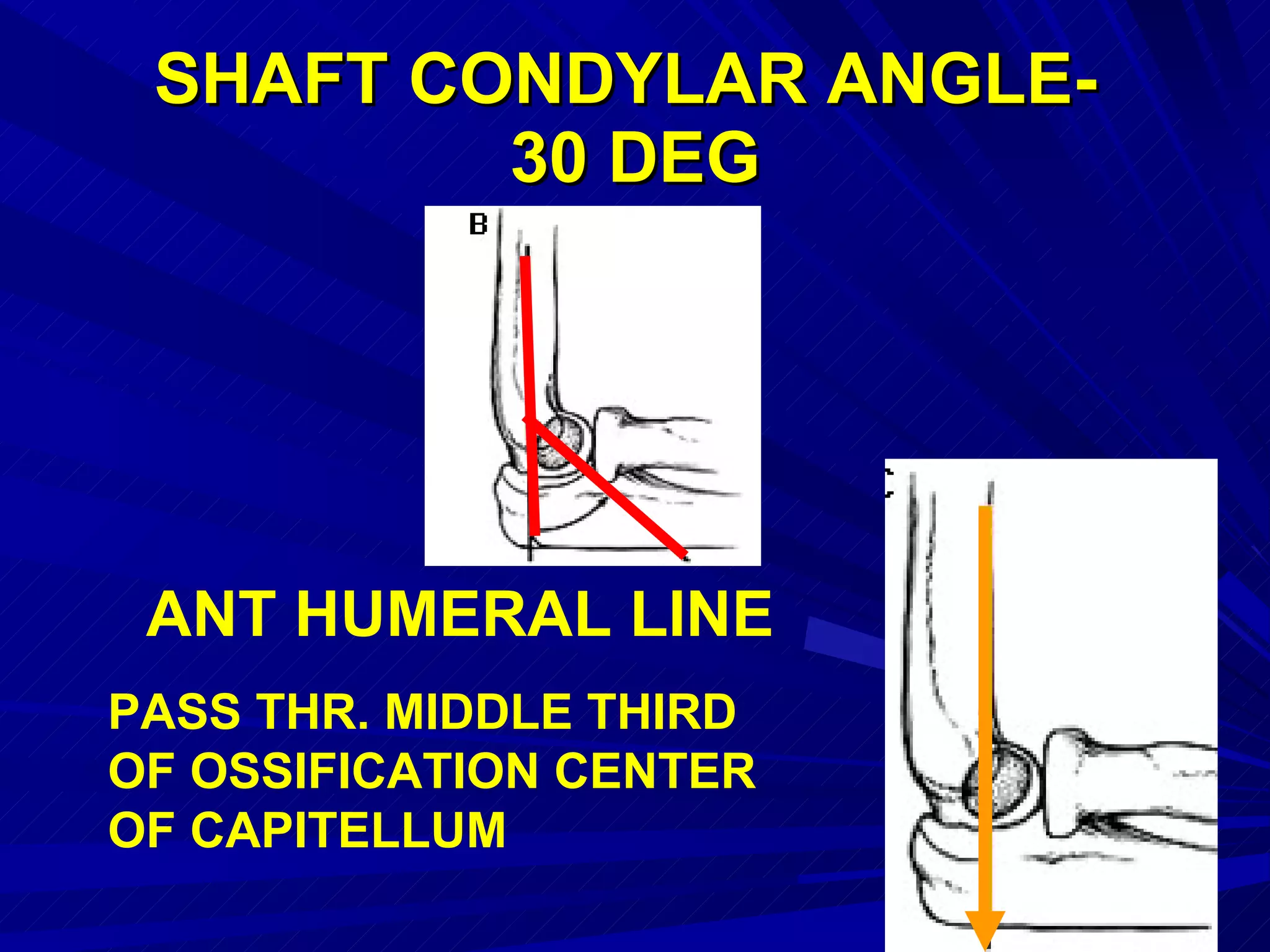 Supracondylar fractures in_children | PPT