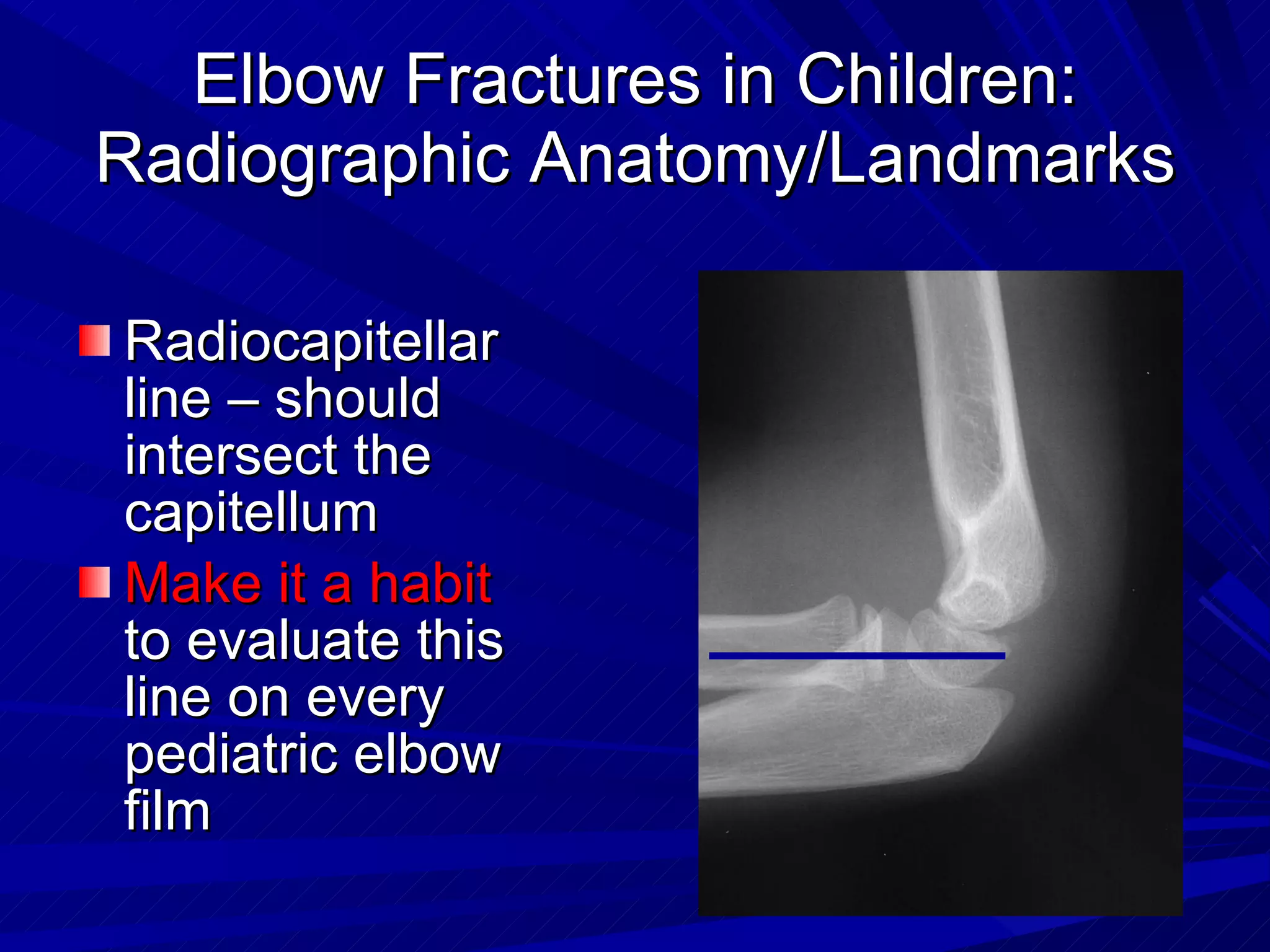Supracondylar fractures in_children | PPT